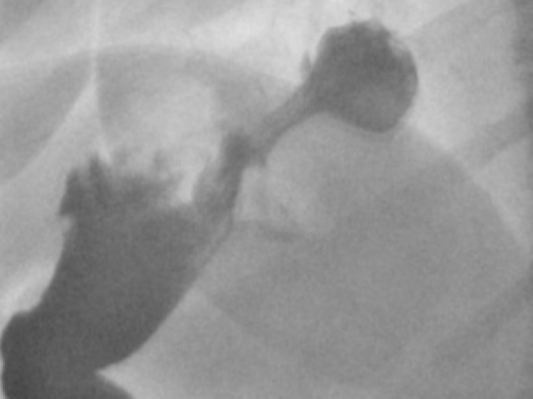 Weight regain after Nissen and N-Sleeve