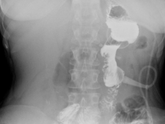 Complication after lap band on a bypass