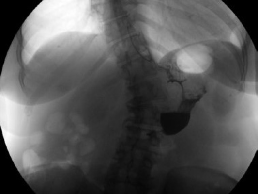 Reversal to normal anatomy after one-anastomosis gastric bypass