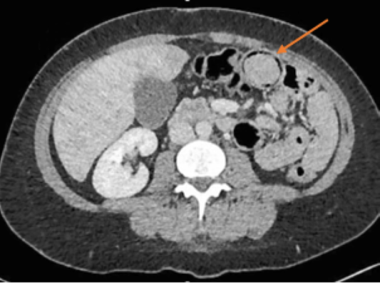 - Shortening and plication of the entero-enterostomy after an ...