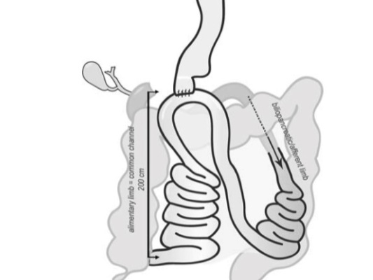 - SADI, with RGA preservation and manual anastomosis with barbed suture ...
