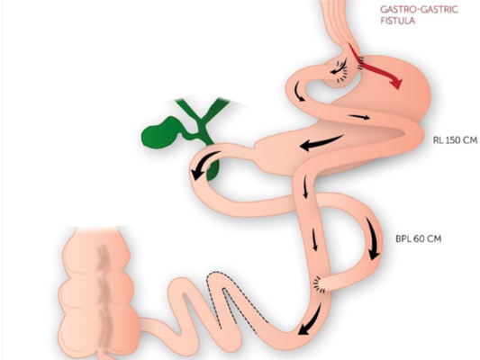BARIAlink - Gastric Bypass reversal for severe malnutrition