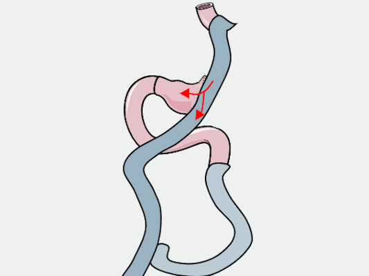 - One anastomosis jejunal interposition with gastric remnant resection ...